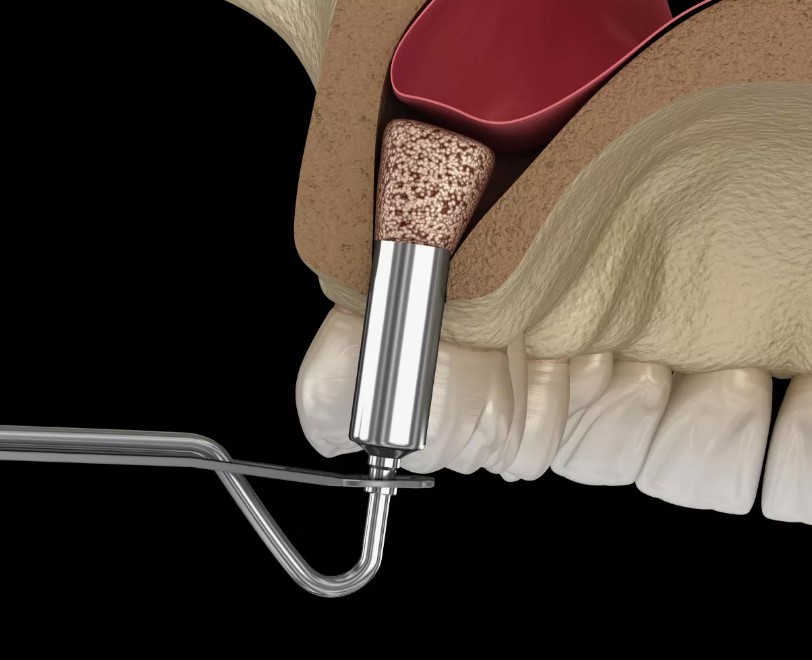 OPEN SINUS LIFTING - Lena Gesundheitsgruppe